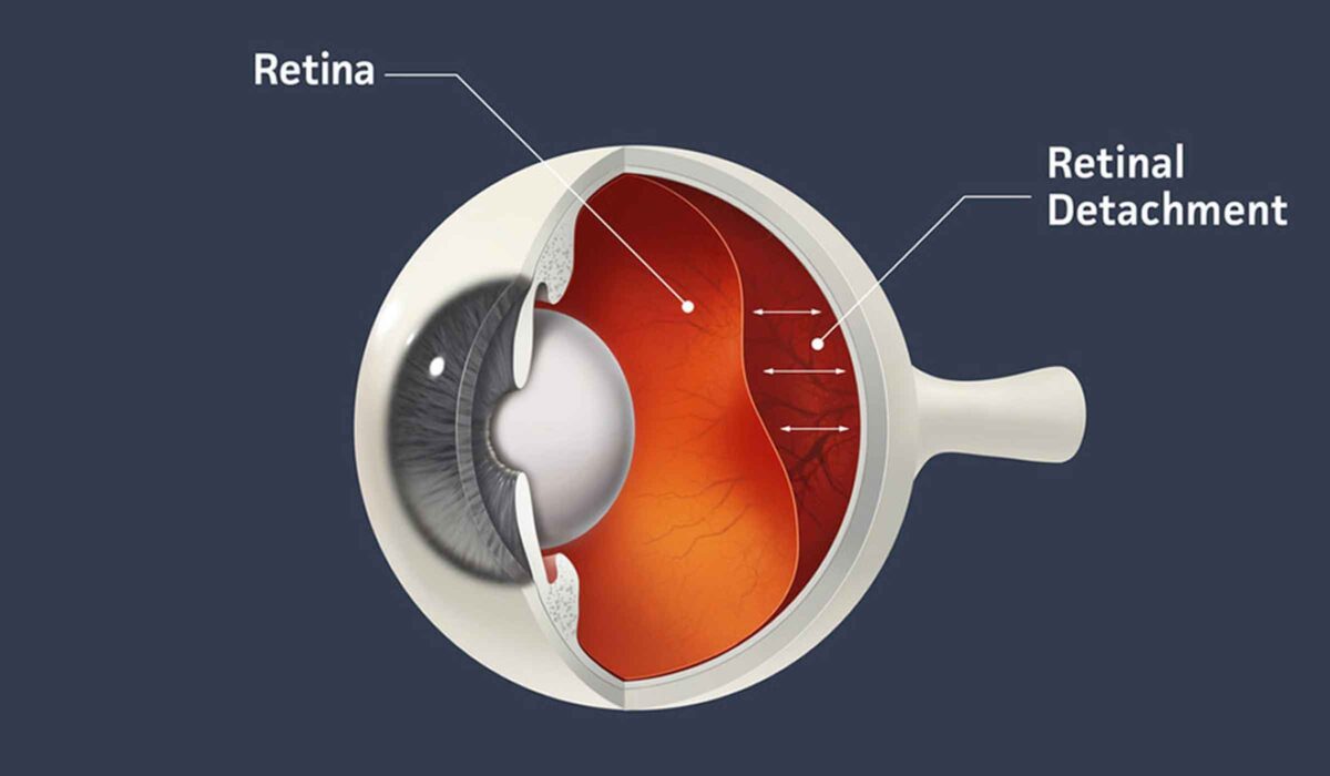 Retina Disease – Georgina Eye Clinic